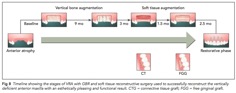 Anterior atrophic maxilla vertical ridge augmentation—Urban(2015) | yehc