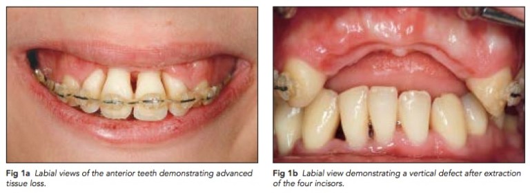 Anterior atrophic maxilla vertical ridge augmentation—Urban(2015) | yehc