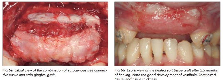 Anterior atrophic maxilla vertical ridge augmentation—Urban(2015) | yehc
