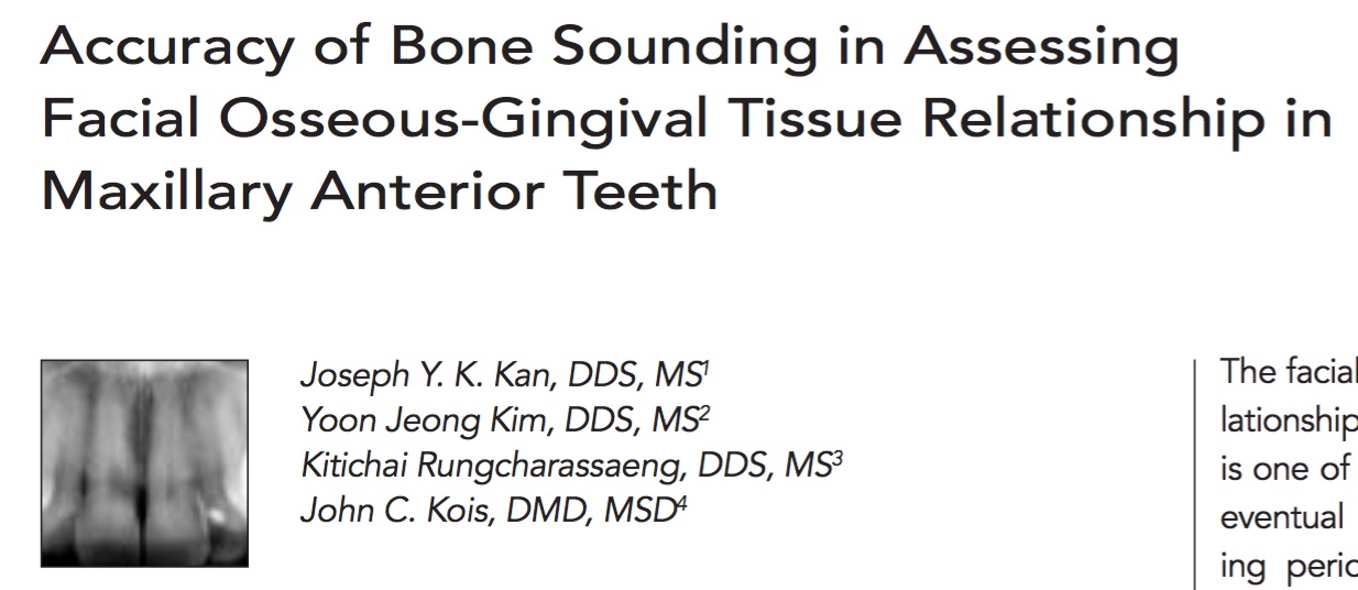 在上顎前牙做bone sounding的準確性—Kan(2017) | yehc